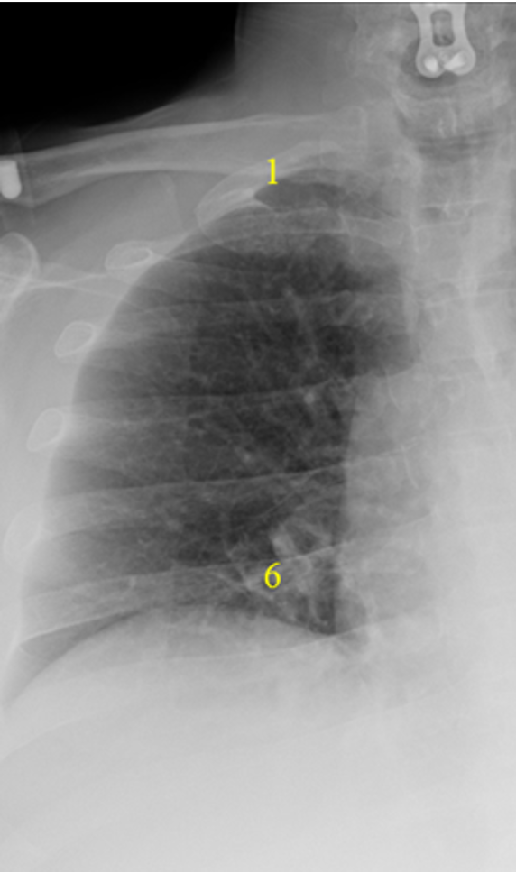 Chest Radiograph