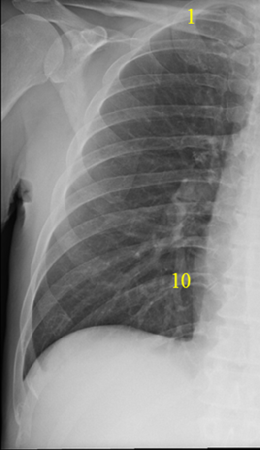 Chest Radiograph