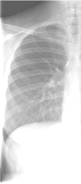 Chest Radiograph