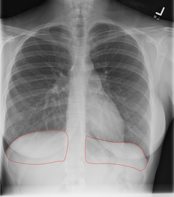 Chest Radiograph
