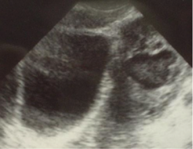 Pelvic Inflammatory Disease and Tubo-ovarian Abscess