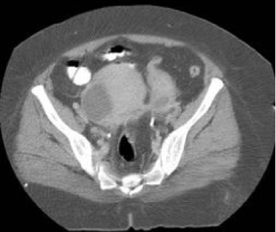 Pelvic Inflammatory Disease and Tubo-ovarian Abscess