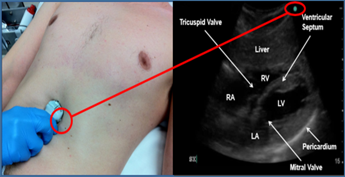 Pericardial effusion