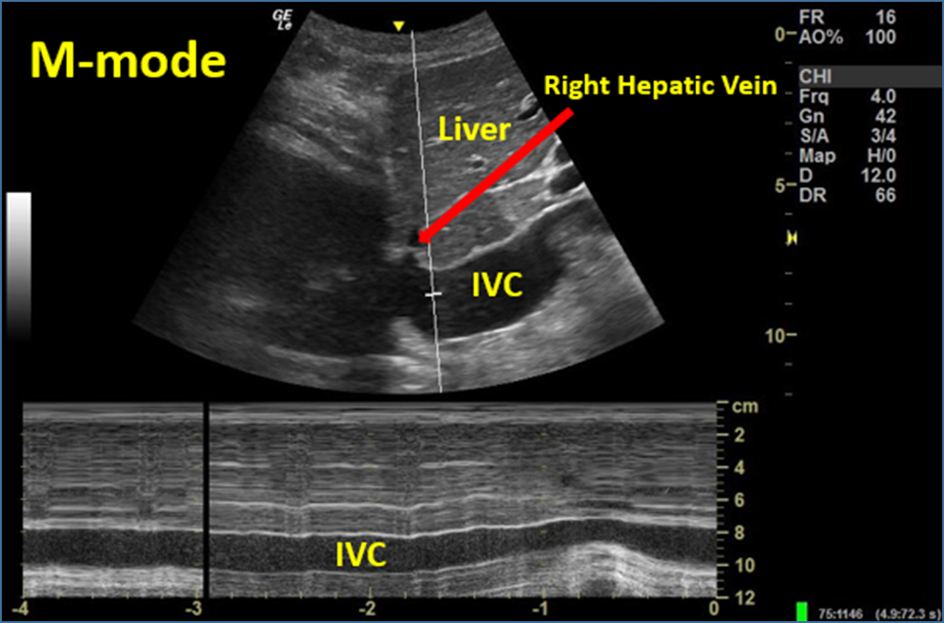 Pericardial effusion