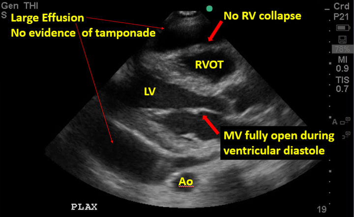 Pericardial effusion