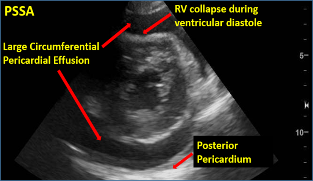 Pericardial effusion