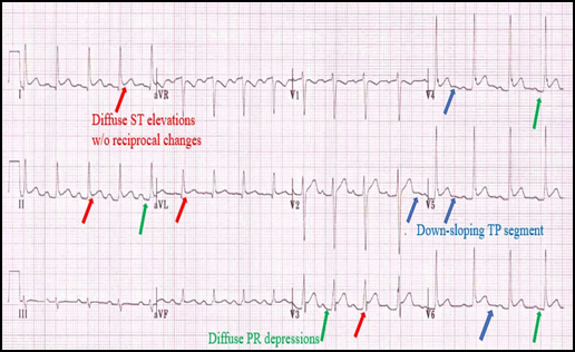 Pericardial effusion