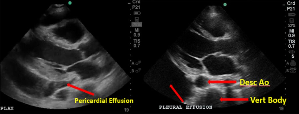 Pericardial effusion